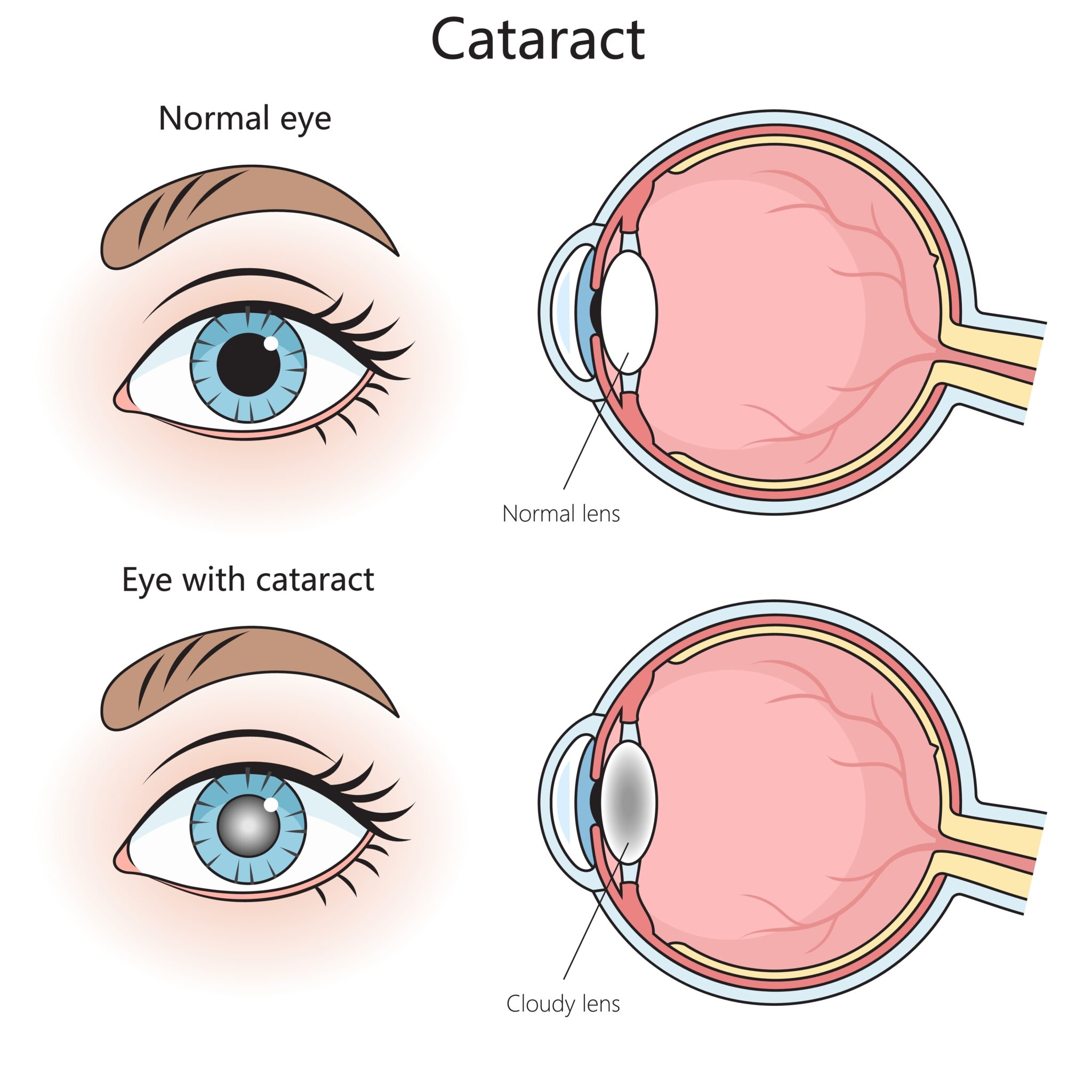 What Happens During Cataract Surgery? | Whitson Vision